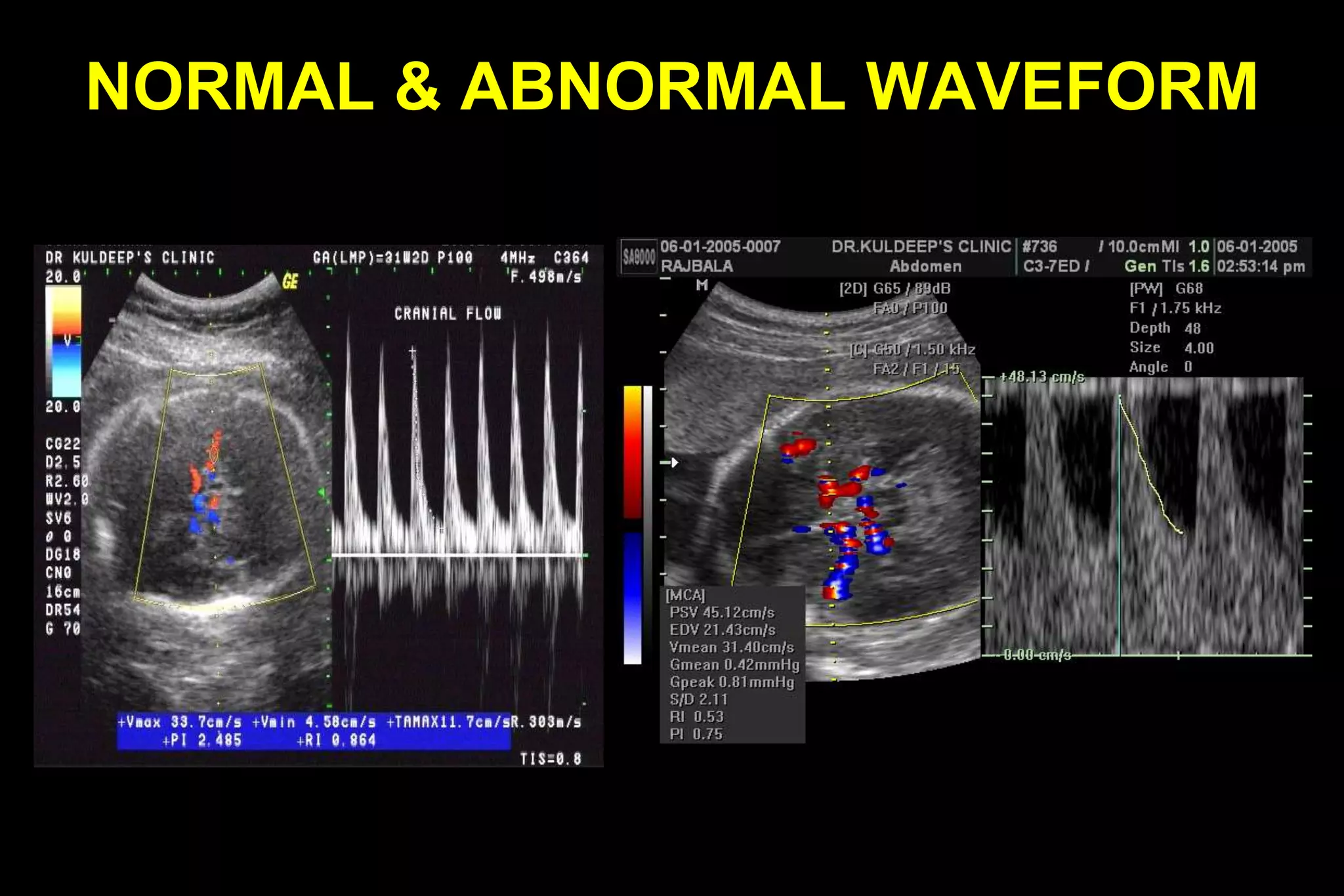Color doppler in fetal hypoxia | PPTX