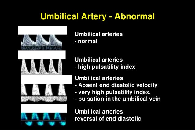 Umbilical Artery Doppler