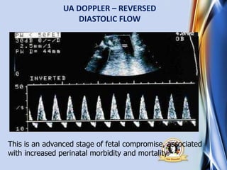 Color doppler in FGR making sence of waves | PPTX