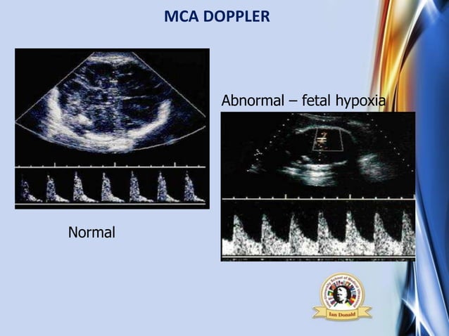 Color doppler in FGR making sence of waves | PPT