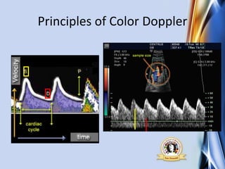 Color doppler in FGR making sence of waves | PPTX