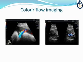 COLOR DOPPLER IN SURVEILLANCE OF PREGNANCY 1.pptx