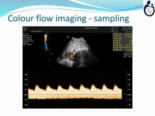 COLOR DOPPLER IN SURVEILLANCE OF PREGNANCY 1.pptx