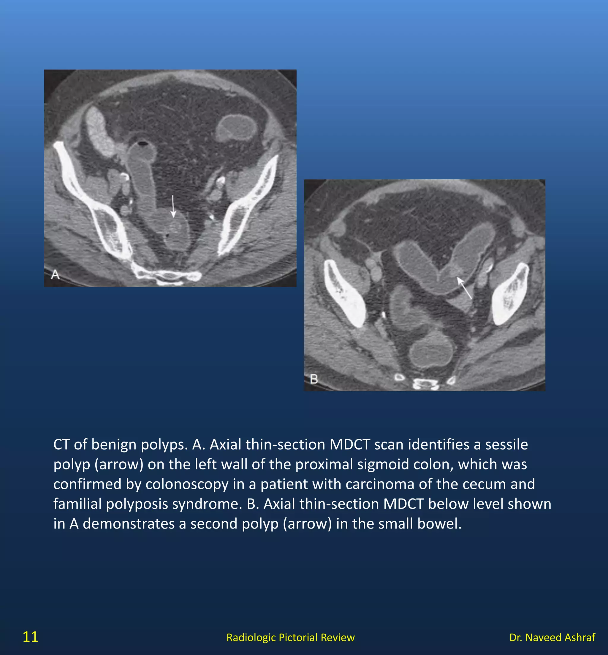 Coloretcal carcinoma | PDF