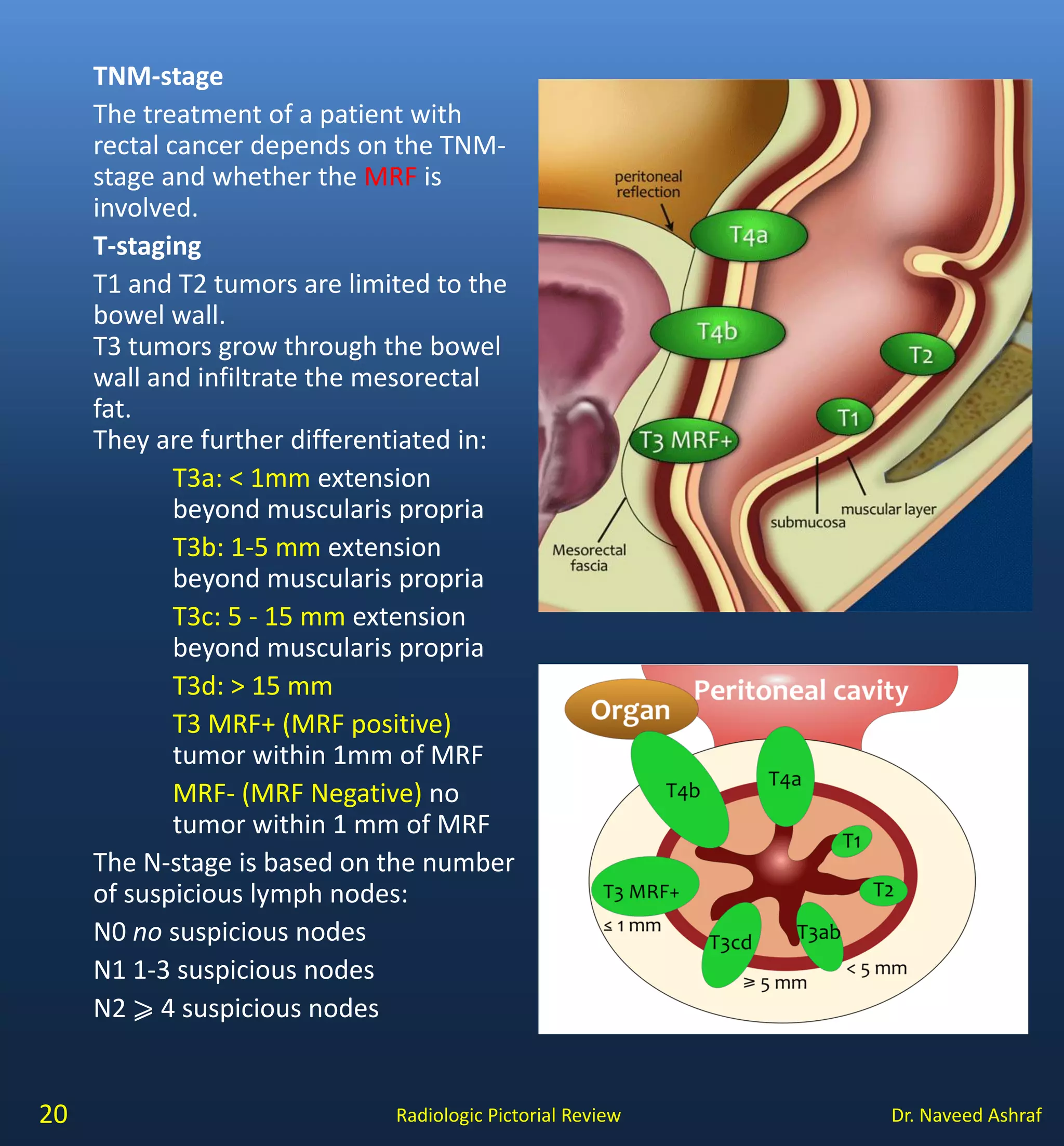 Coloretcal carcinoma | PDF