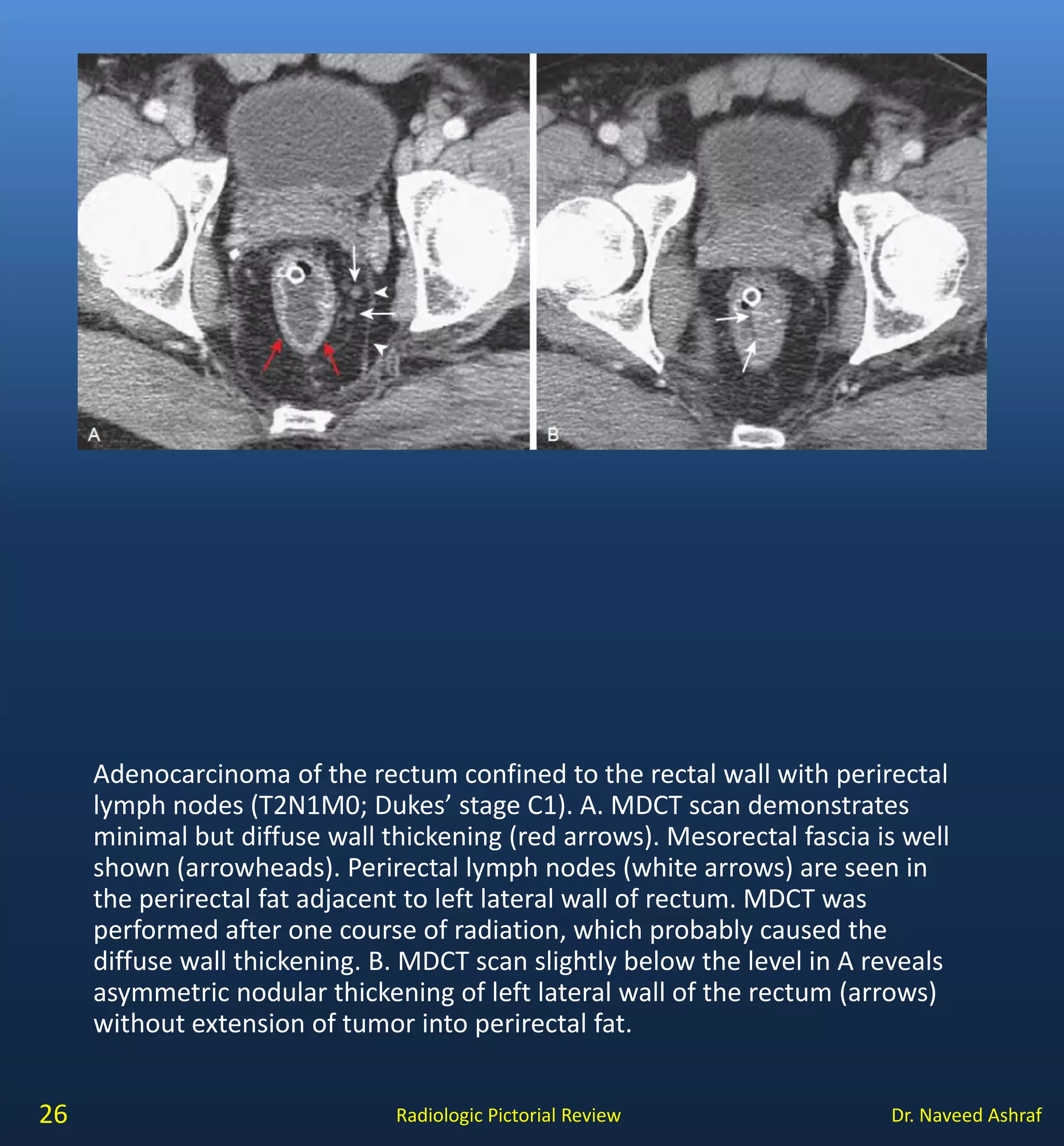 Coloretcal carcinoma | PDF