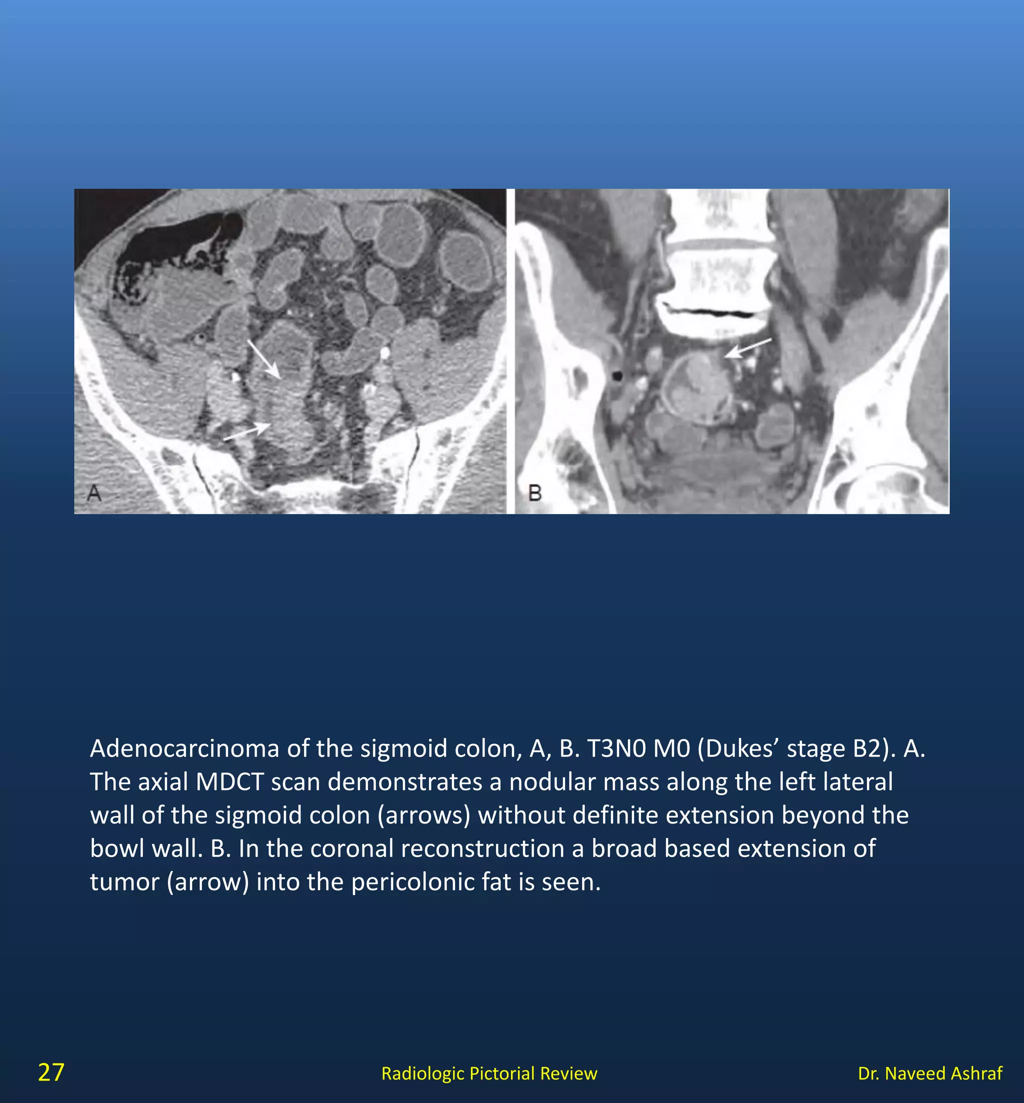 Coloretcal carcinoma | PDF