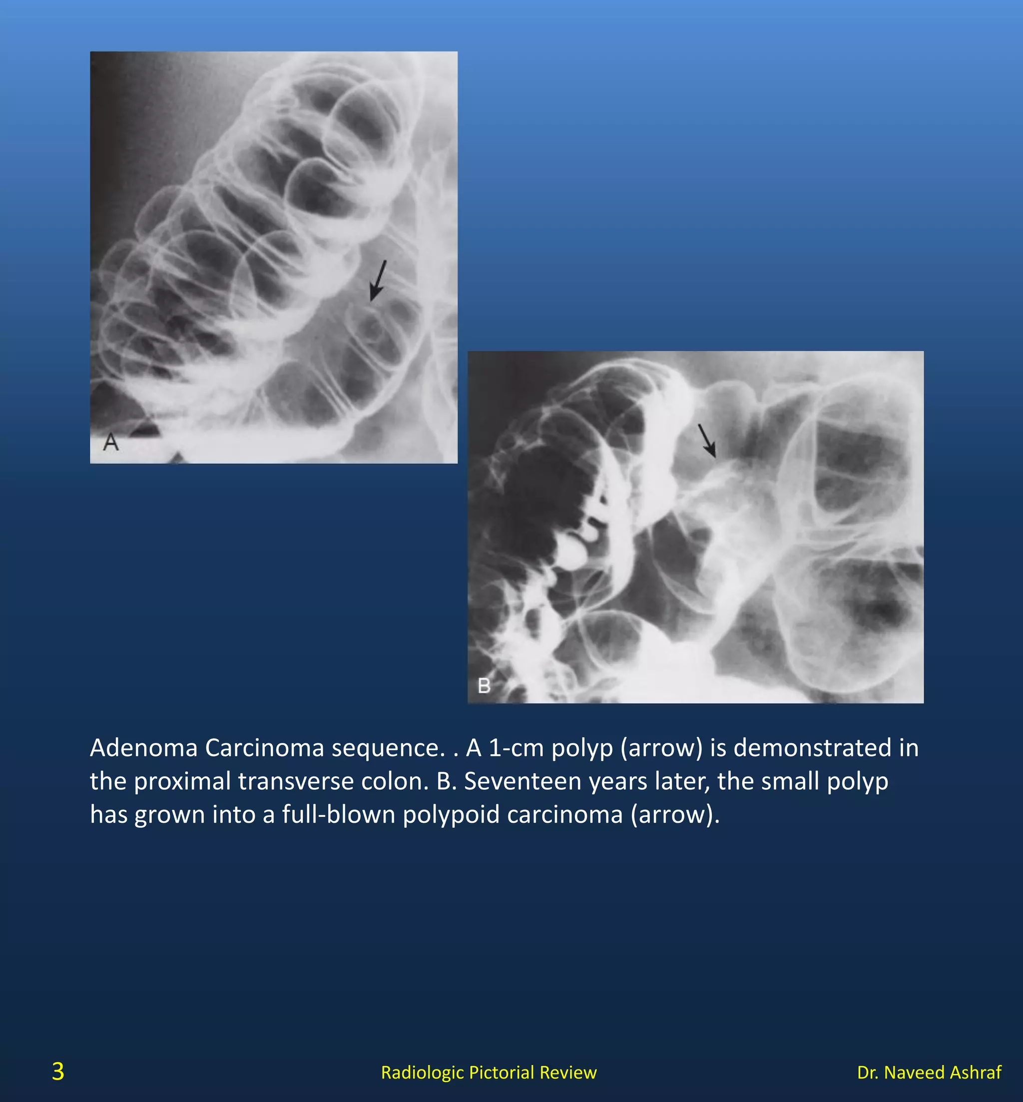 Coloretcal carcinoma | PDF