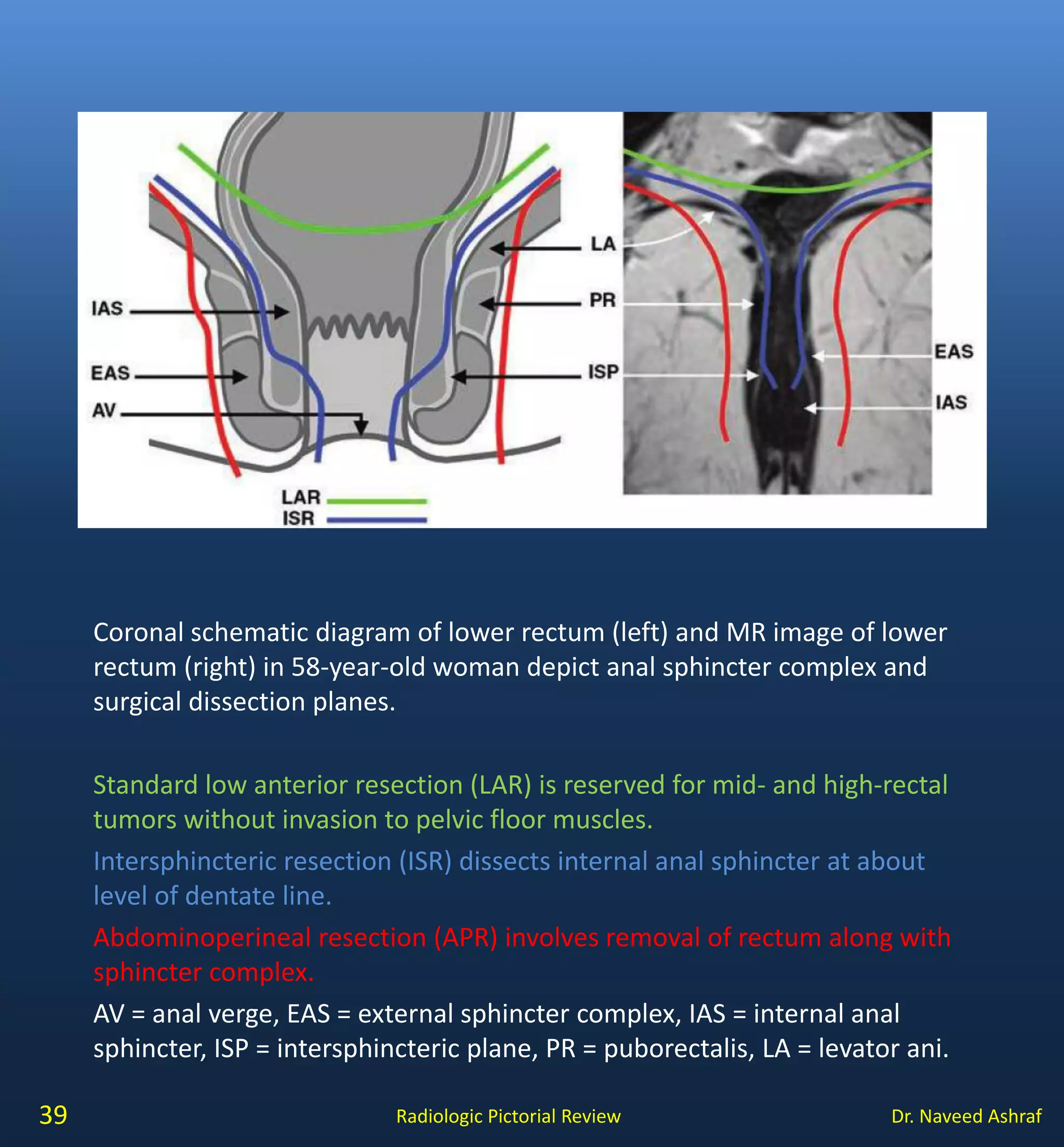 Coloretcal carcinoma | PDF