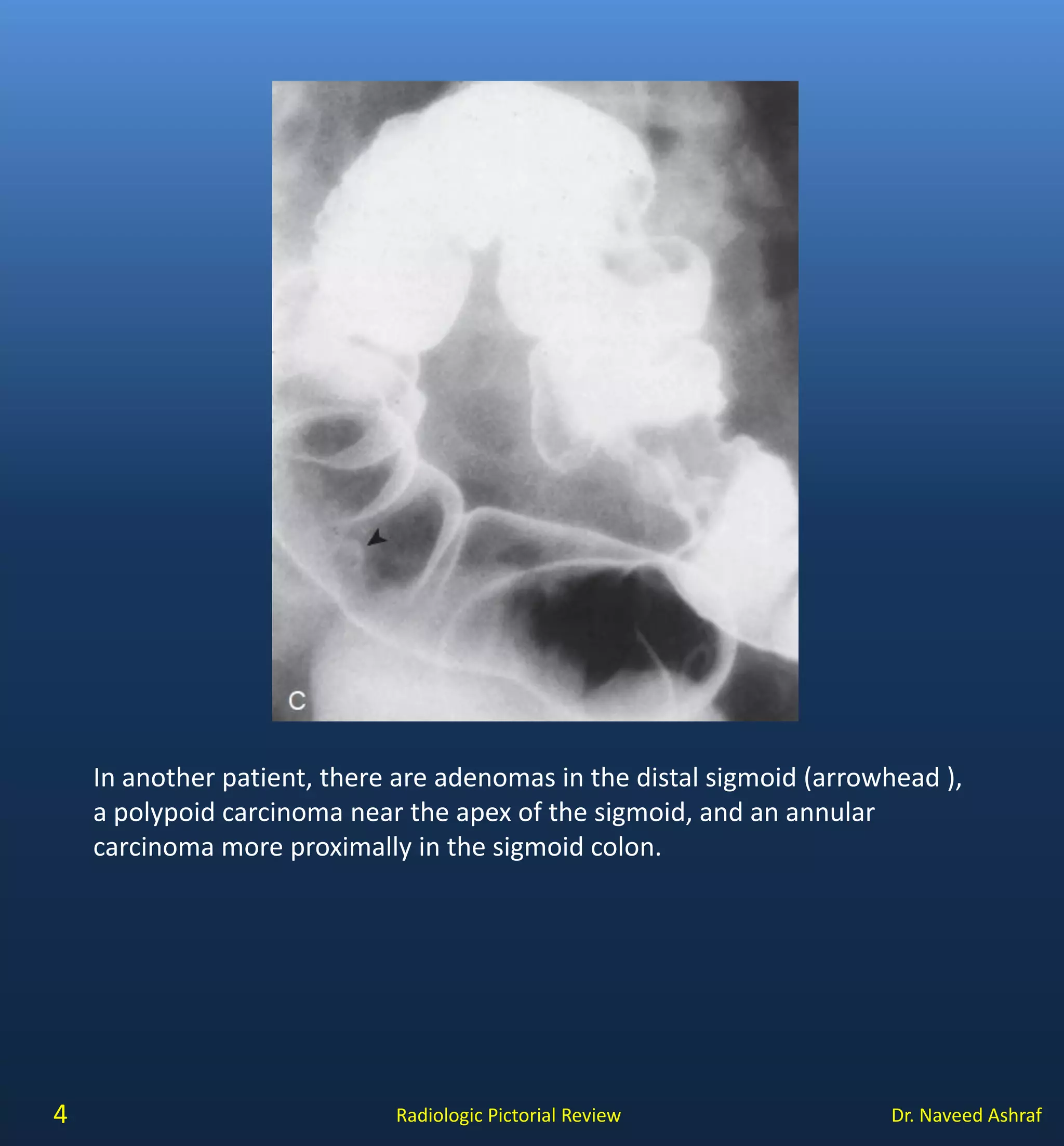 Coloretcal carcinoma | PDF