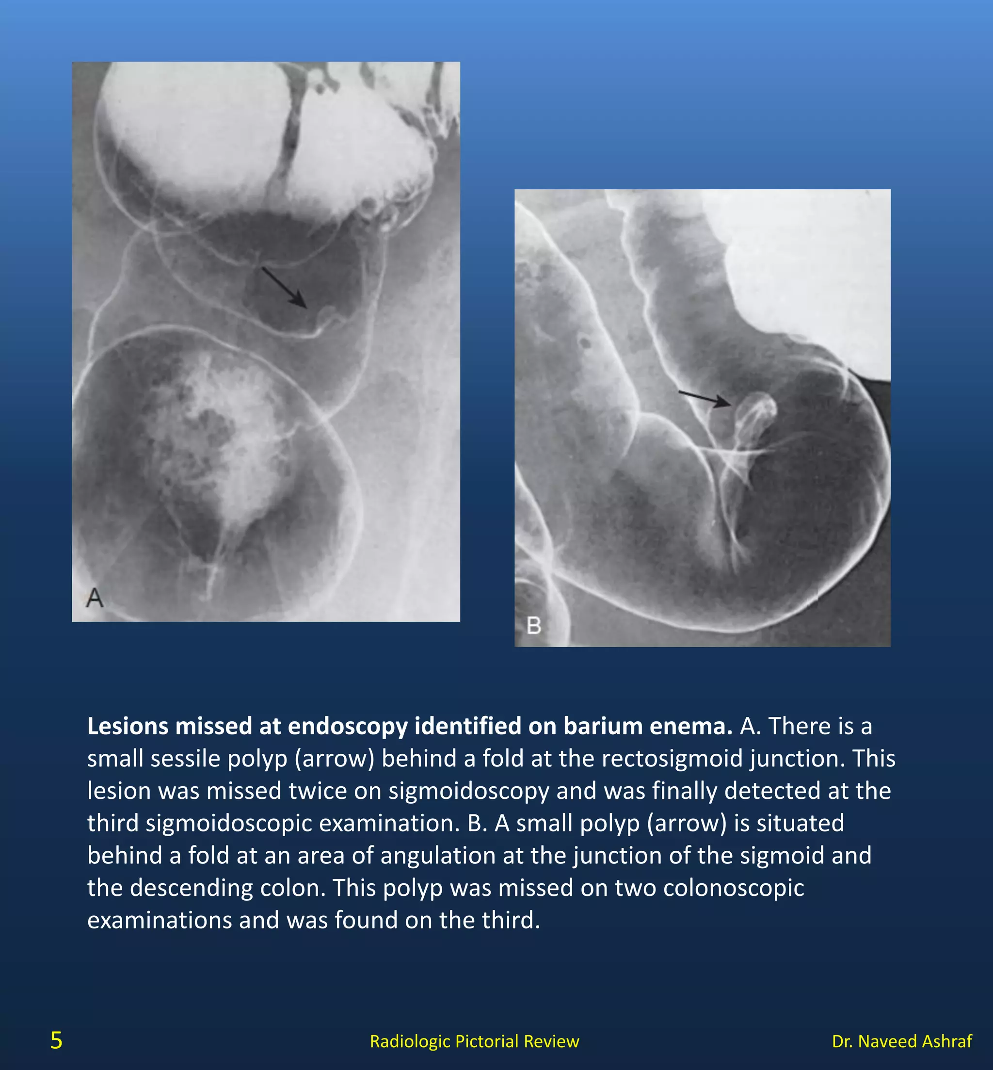 Coloretcal carcinoma | PDF