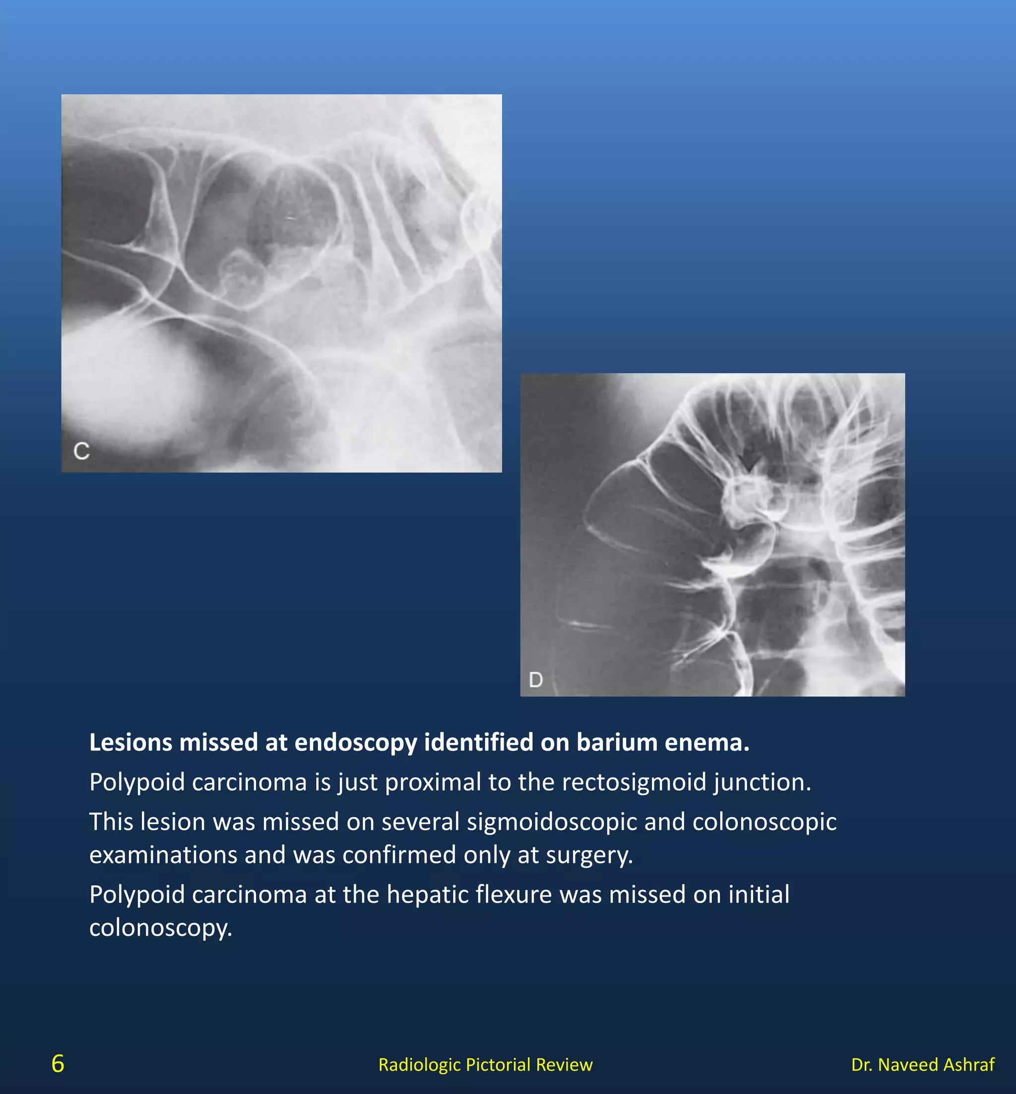 Coloretcal carcinoma | PDF