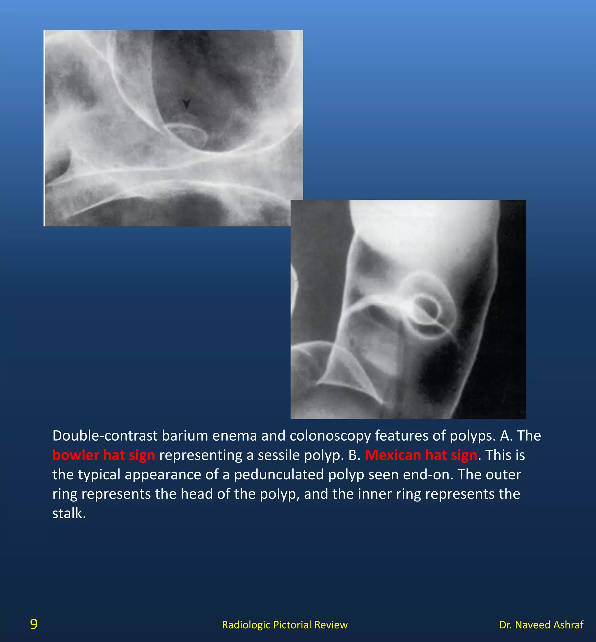 Coloretcal carcinoma | PDF