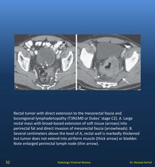 Coloretcal carcinoma | PDF