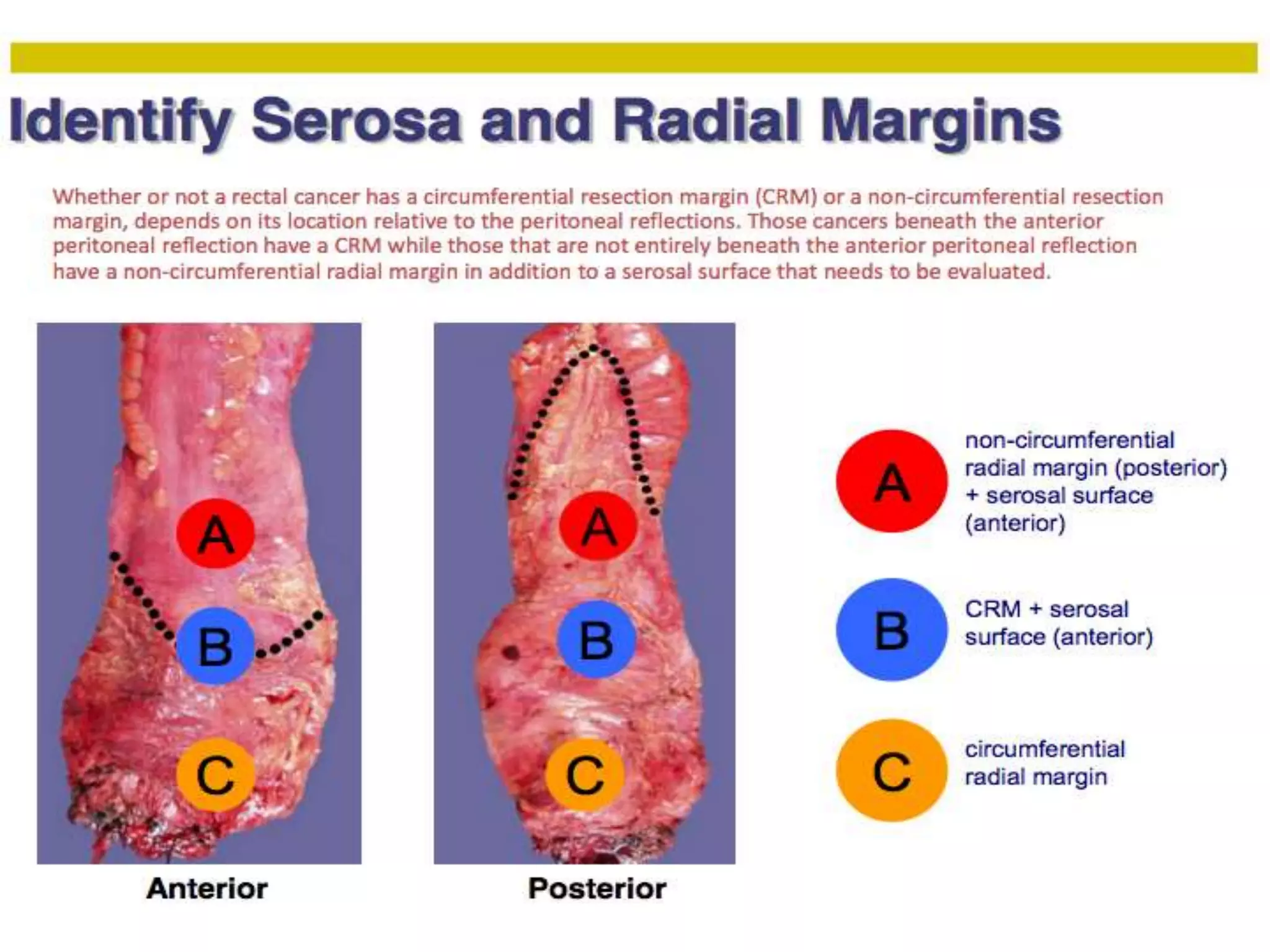 grossing of Colorectal specimens | PPTX
