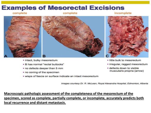 grossing of Colorectal specimens | PPTX