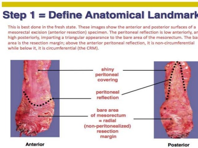 grossing of Colorectal specimens