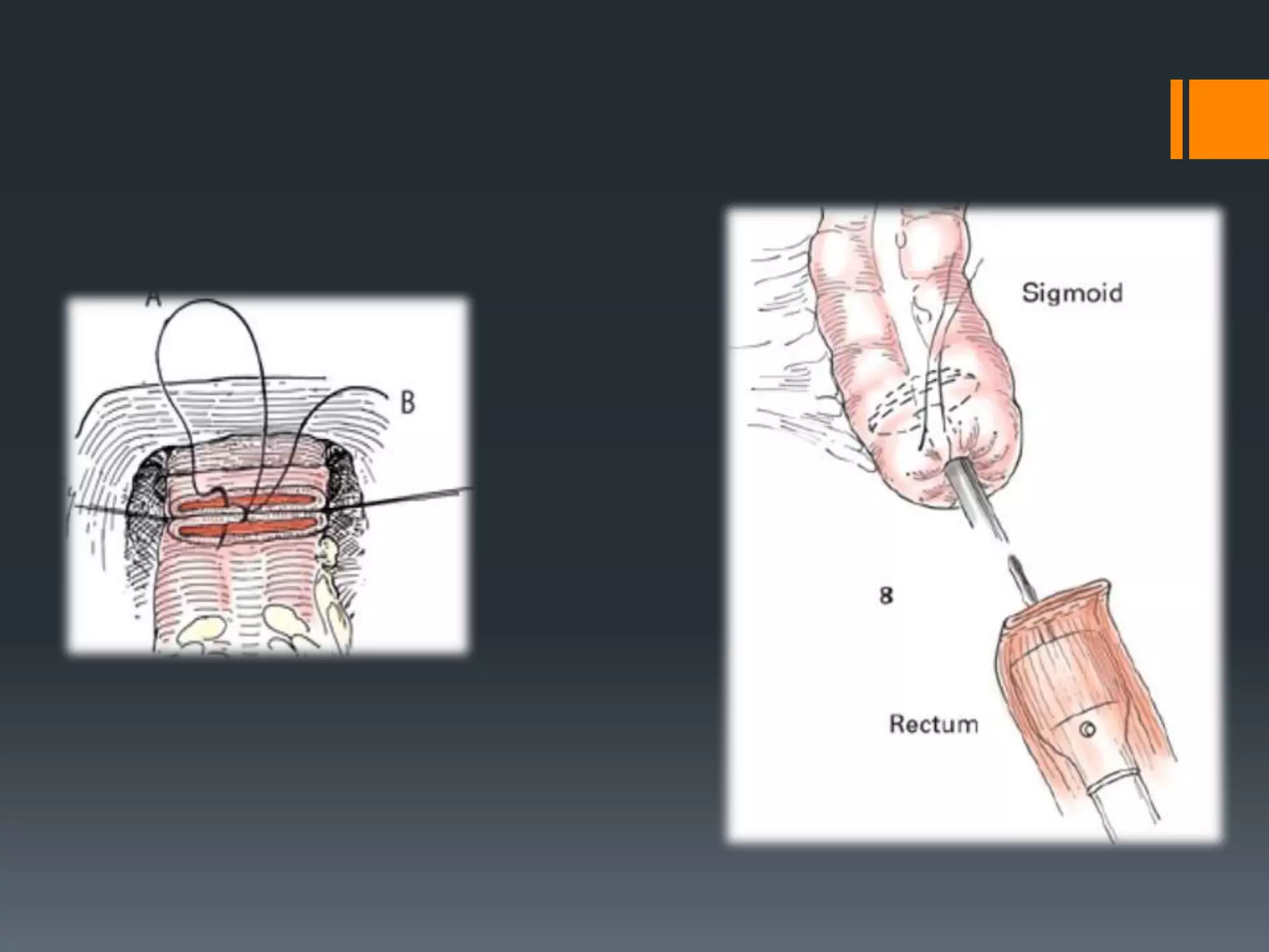 Colorectal anastomosis | PPTX