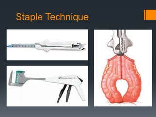 Colorectal anastomosis | PPTX