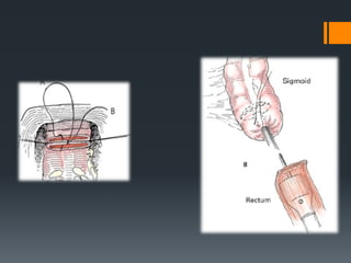 Colorectal anastomosis | PPTX