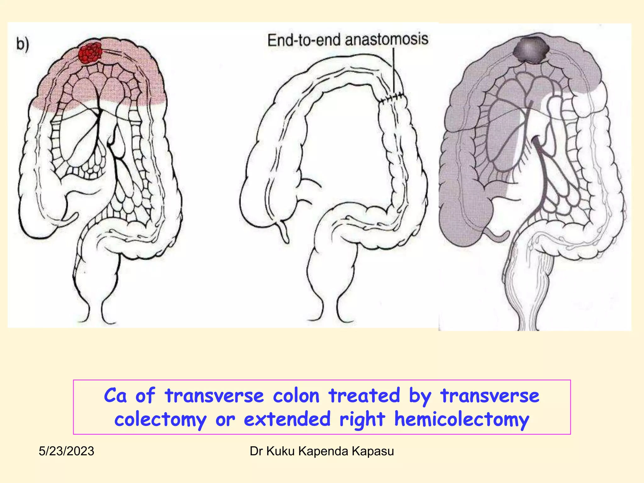 colorectal_ca- COG.ppt | Digestive Disorders | Diseases and Conditions