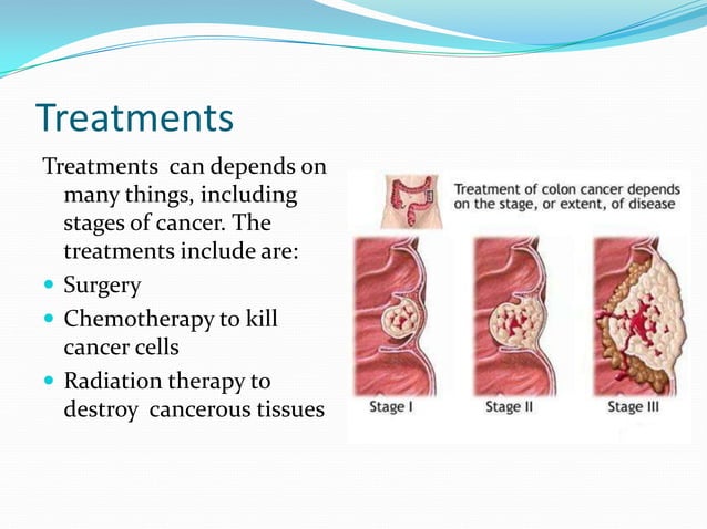 Colorectal Cancer | PPT