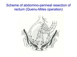 Colorectal cancer | PPT