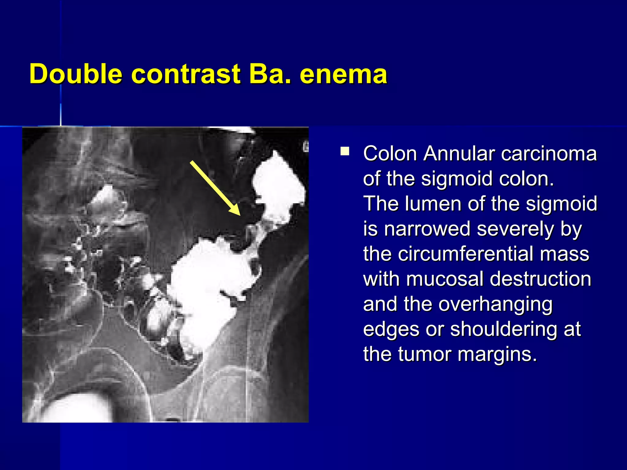 Colorectal cancer | PPT