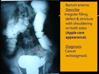 Colorectal cancer | PPT