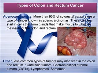 Colorectal Cancer Awareness | PPT