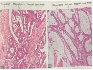 colorectal cancer pathology ppt. 5.pptx