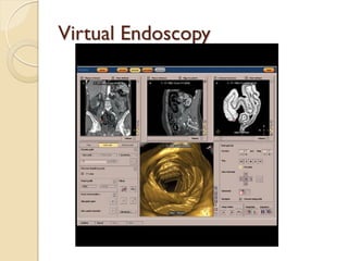 colorectalcancesample and diagnosis and treatment | PPT