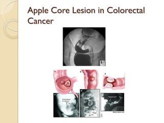 colorectalcancesample and diagnosis and treatment | PDF