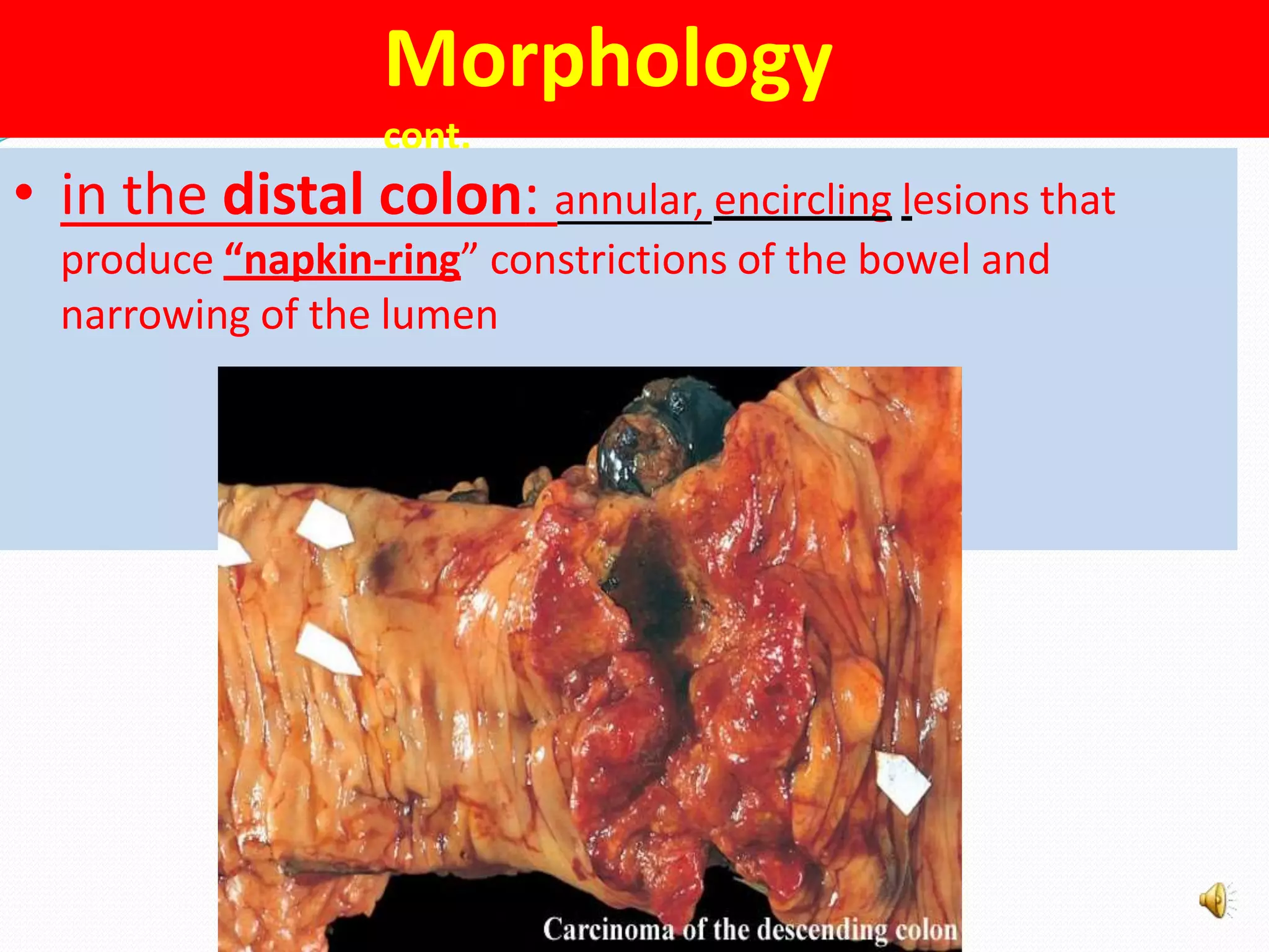 Colorectal carcinoma gist carcinoid tumour | PPTX