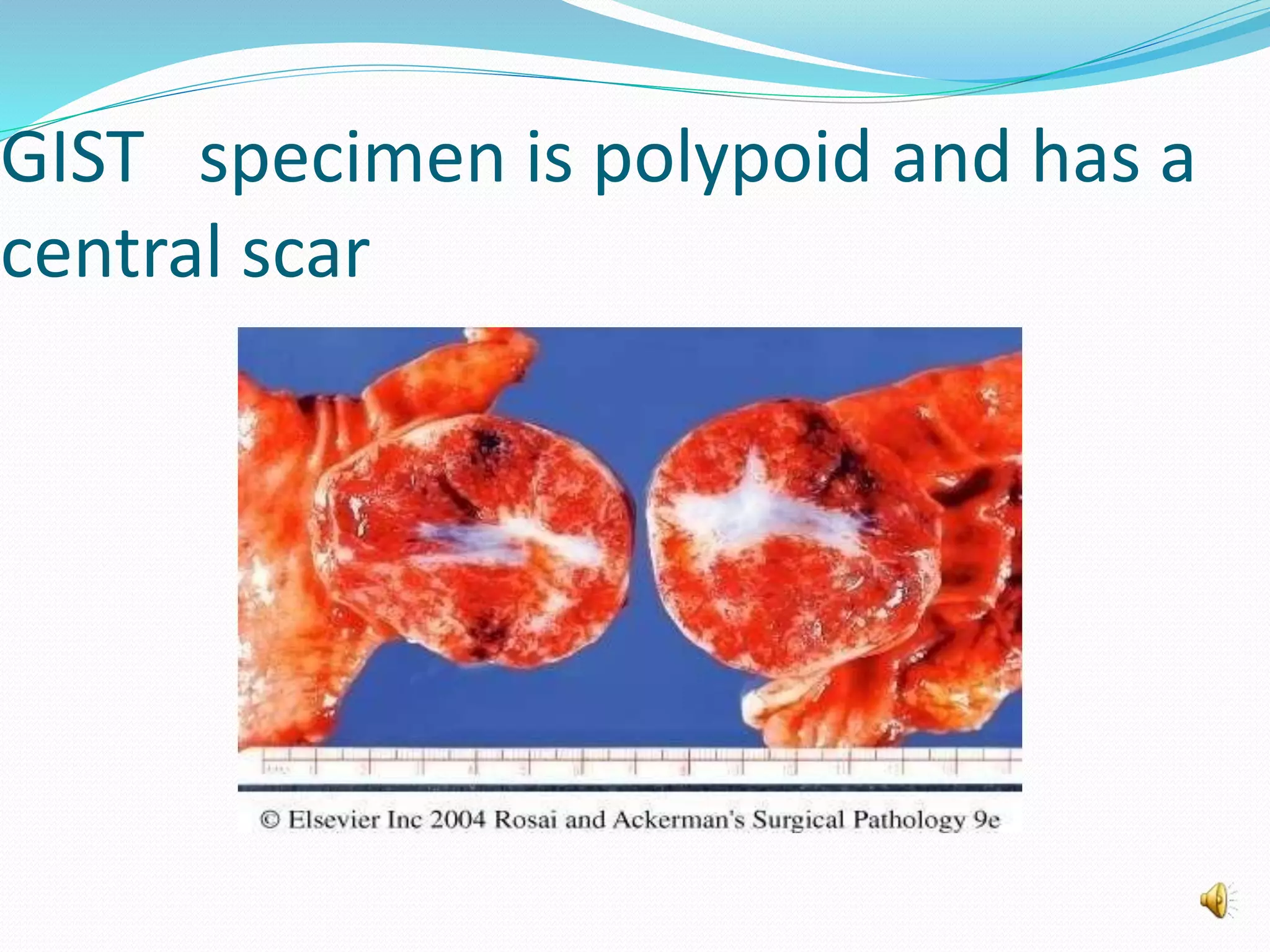 Colorectal carcinoma gist carcinoid tumour | PPTX