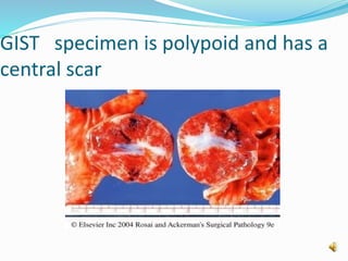 Colorectal carcinoma gist carcinoid tumour | PPTX