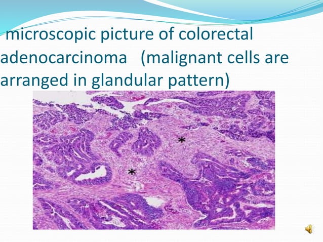 Colorectal carcinoma gist carcinoid tumour | PPT
