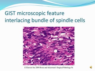 Colorectal carcinoma gist carcinoid tumour | PPTX