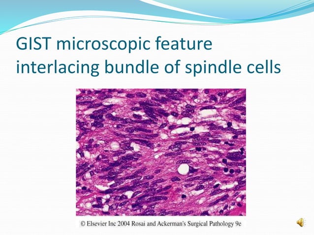 Colorectal carcinoma gist carcinoid tumour | PPT