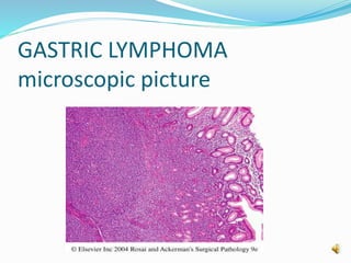 Colorectal carcinoma gist carcinoid tumour | PPTX