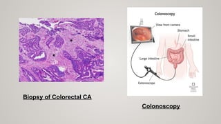 Colorectal Carcinoma presentation 1.pptx