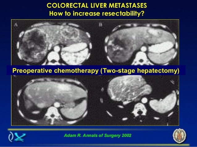 Colorectal liver metastases (Dr Juan Carlos Meneu Diaz). Oncocir. Cli…