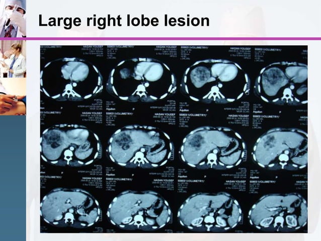 Colorectal Liver Metastases Multidisciplinary Approach 2 2 Ppt