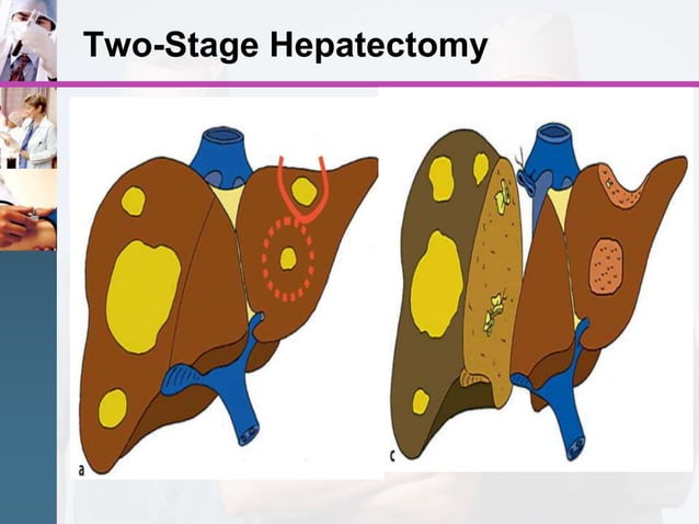 Colorectal Liver Metastases Multidisciplinary Approach 2 2 Ppt