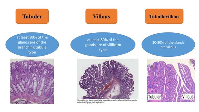 Colorectal Polyp.pptx | Digestive Disorders | Diseases and Conditions