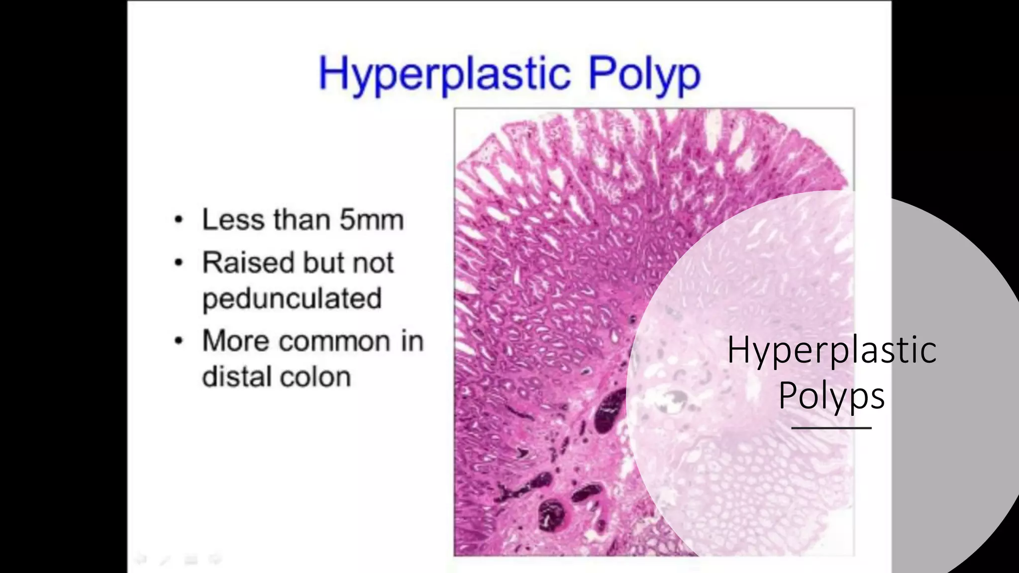 Colorectal polyps1.pptx