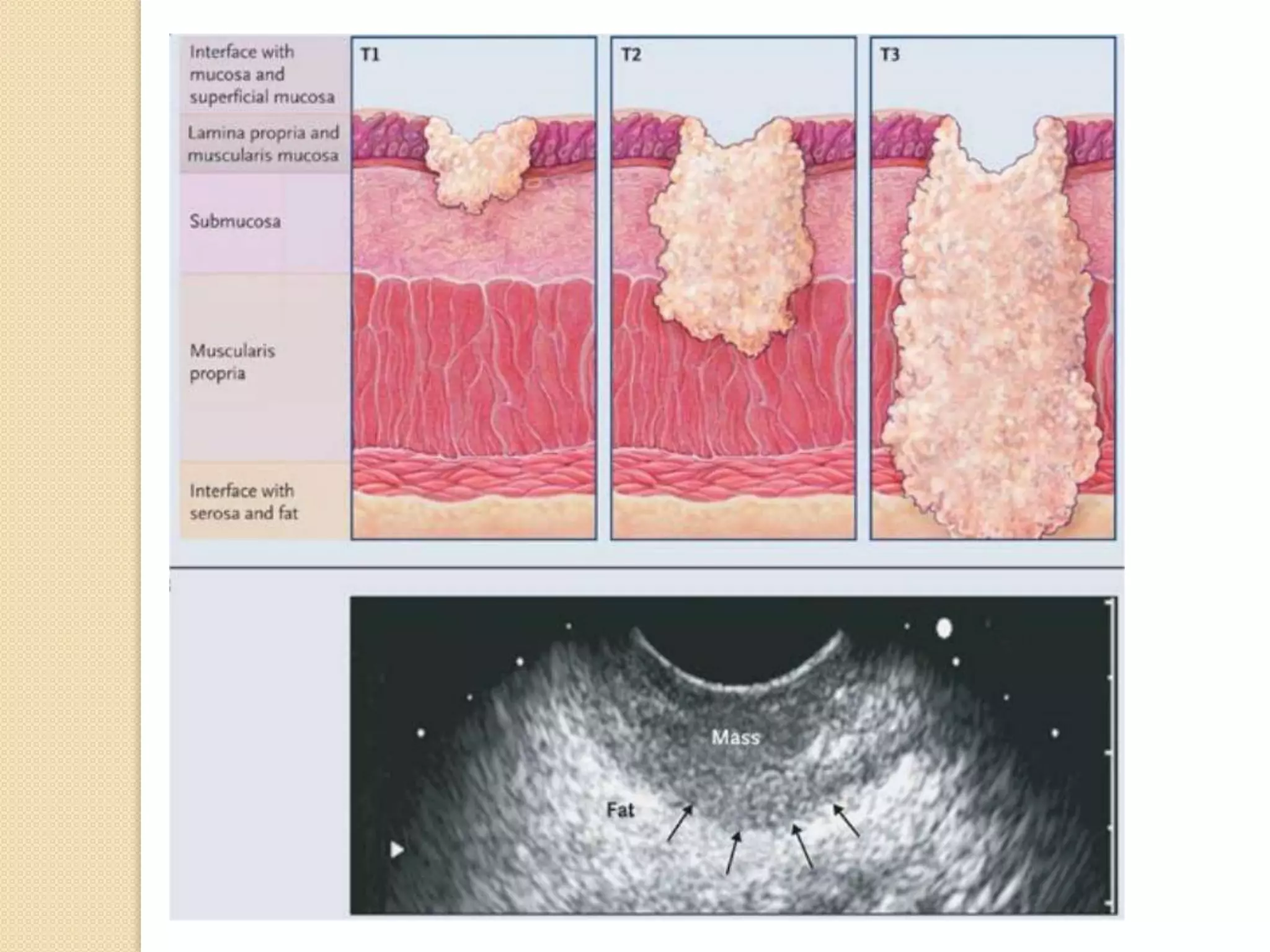 Radiation for Colon and Rectal Cancer | PPTX