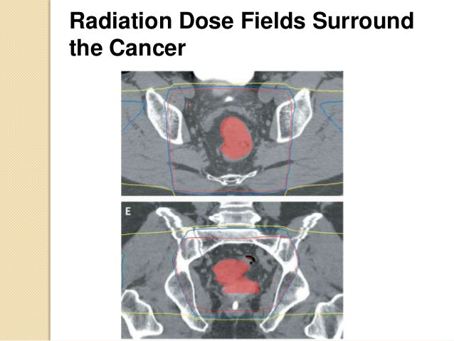 Radiation for Colon and Rectal Cancer