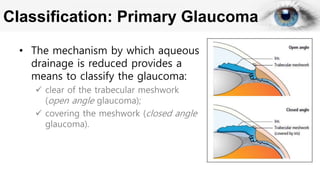Glaucoma | PPTX
