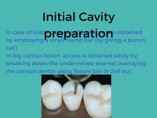 Conservative Dentistry: Class I Cavity preparation | PPTX | Dental Health | Diseases and Conditions